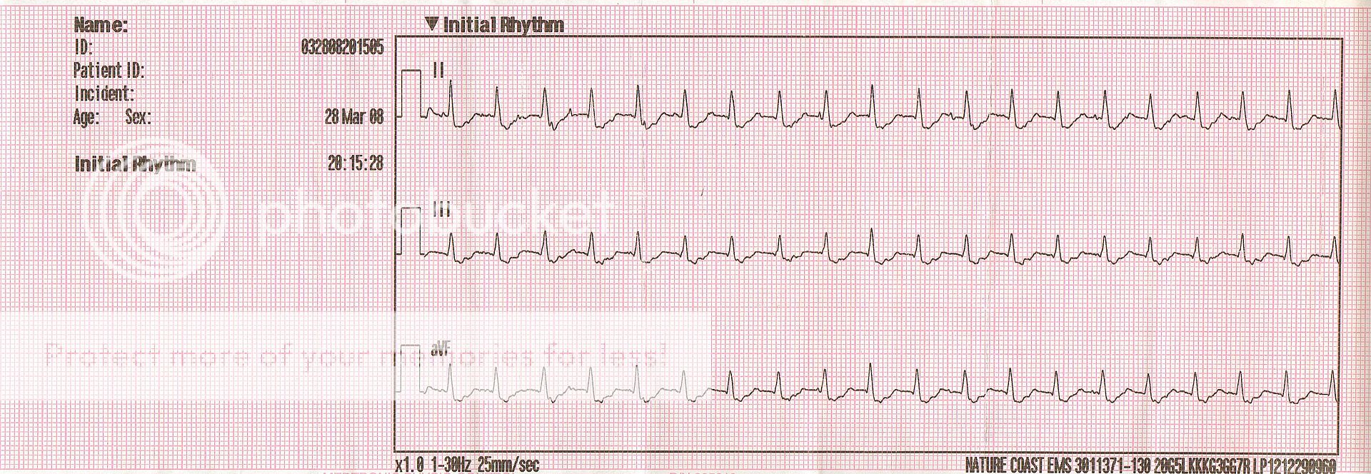 EKG Interpretation (WPW, delta waves?) 56k... meh. | EMTLIFE
