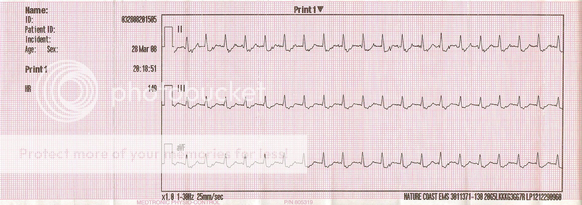 EKG Interpretation (WPW, delta waves?) 56k... meh. | EMTLIFE
