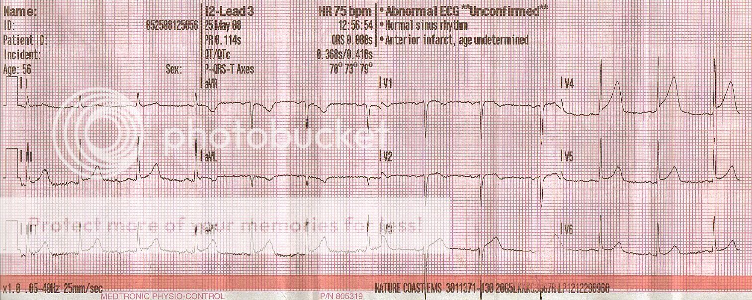 EKG Strip: Progression of ST Elevation | EMTLIFE
