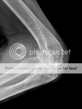 Delivering Allograft Bone Chips | Aches & Joints