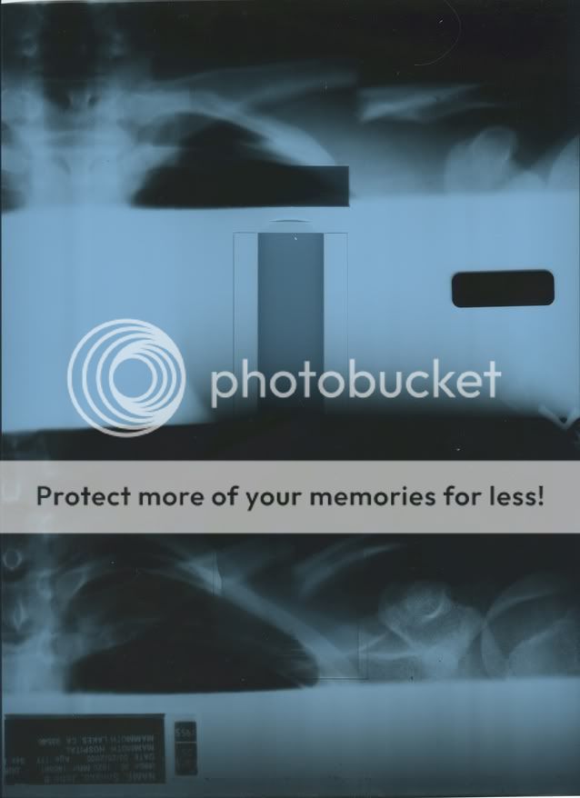 lets see your worst bumps and bruises from snowboarding, here's mine ...