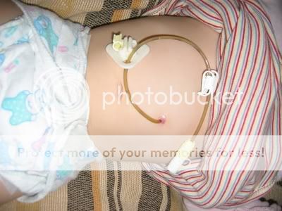 PEG - viele Fragen - REHAkids