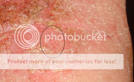 day 137 | Juliana's Topical Steroid Withdrawal Journey