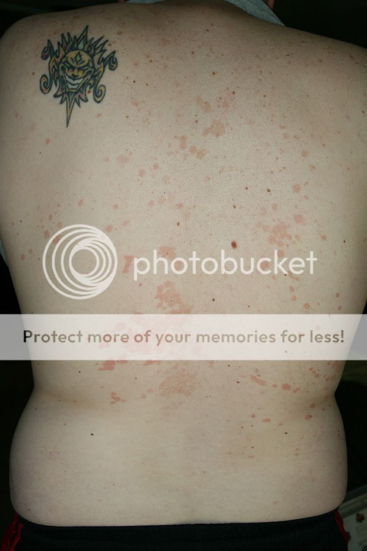 "Rash on my back is growing!": Skin Problems & Treatments Community ...