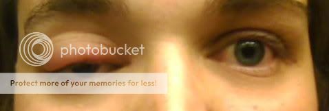 2 year old daughter diagnosed with MRSA | BabyCenter